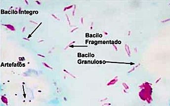 Saúde Pública - Sintomas E Diagnóstico Laboratorial De Hanseníase ...
