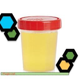 Urina Com Aspecto Turvo No Resultado Do Exame EAS, Causas Mais Comuns