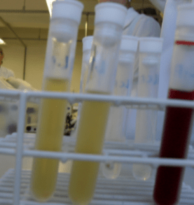 ADA - Adenosina Deaminase, para que serve o exame e detalhes sobre ...