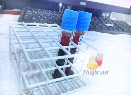 Complemento C3 Sérico, Como Coletar O Sangue Para Este Exame E Quando ...